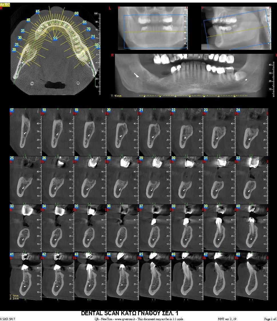 Dental Scan Cbct ΑΞΟΝΙΚΗ ΤΟΜΟΓΡΑΦΙΑ ΓΑΝΘΩΝ